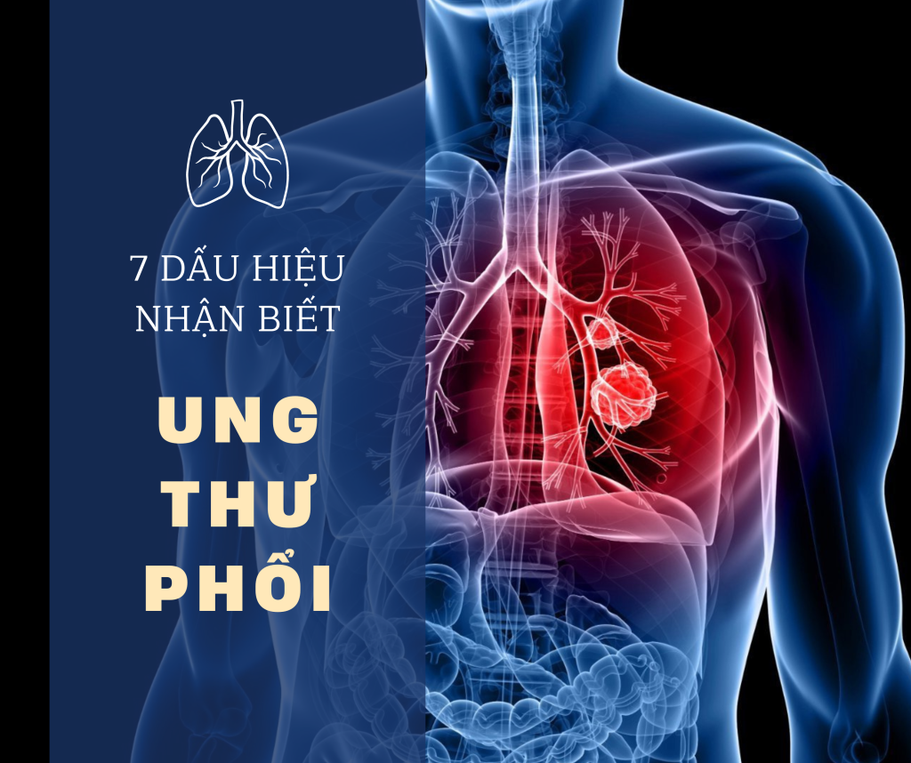7 Dấu Hiệu Nhận Biết Ung Thư Phổi Thường Bị Bỏ Qua